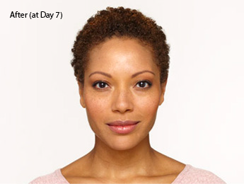 Botox Before & Afters - Torrance Med Spa | Coolsculpting Torrance ...