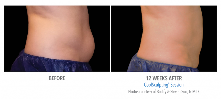 Women's Coolsculpting Before & Afters | Torrance Med Spa ...